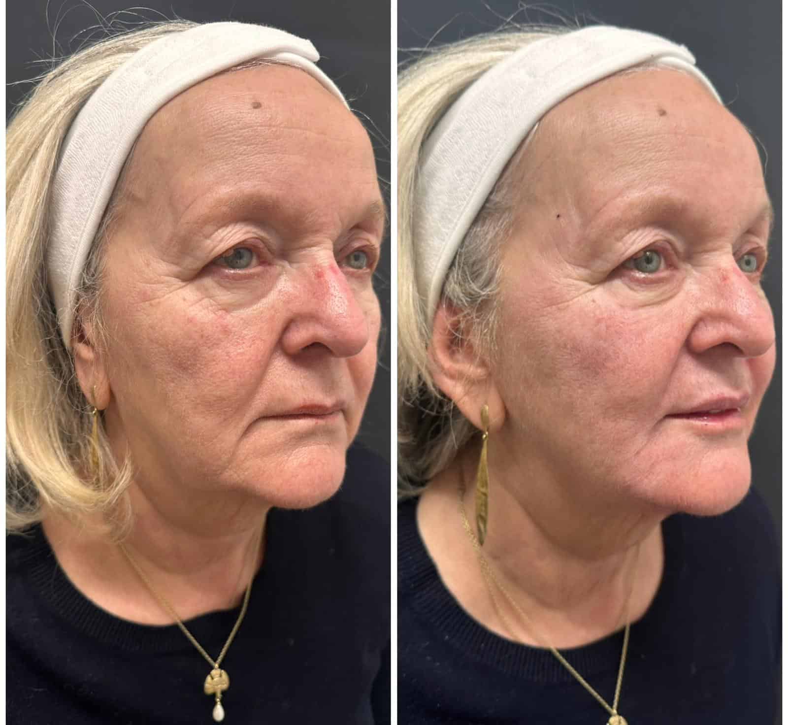 9 Myths, Misconceptions, and Injectables: What You Need to Know